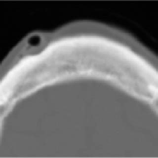 Image result for Intrapulmonary Shunt Bubble Study