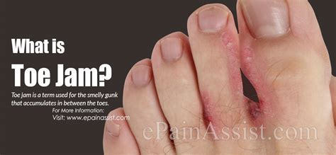 Image result for Toe Jam Build Up