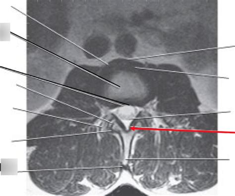Image result for How to View MRI Disc