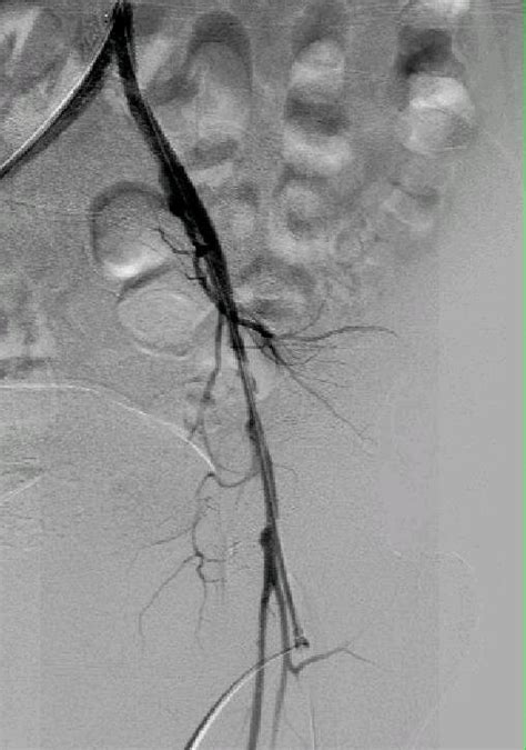 Image result for Left Lower Extremity Angiogram