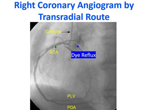 Image result for Angiogram Radial