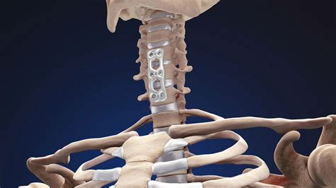 Image result for ACDF Surgery Is Serious