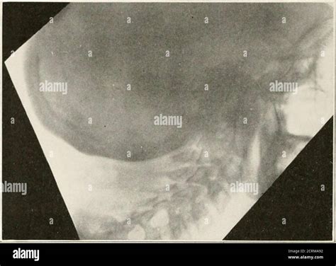 Basilar invagination hi-res stock photography and images - Alamy