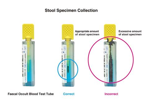 Image result for How to Collect Stool Sample at Home