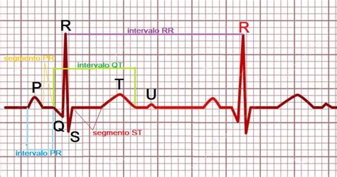 Image result for ECG 12 Derivaciones Normal