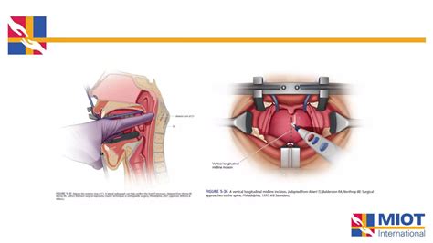 Image result for Basilary Invagination