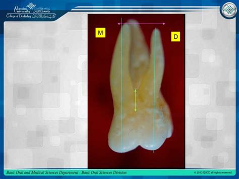 Image result for Maxillary First Molar