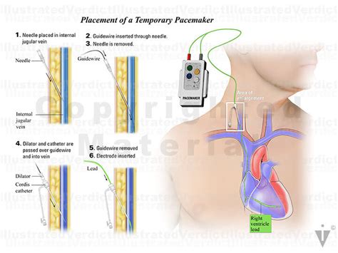 Image result for Remove a Pacemaker and Install Defibrillator