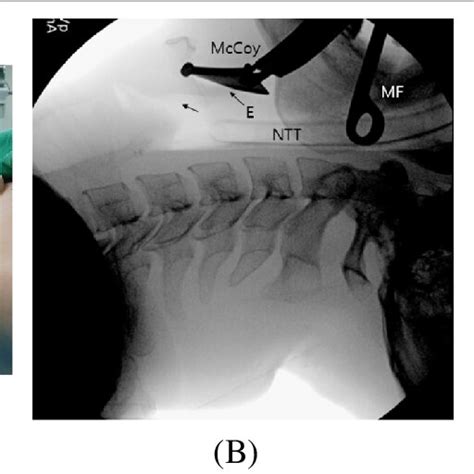 Image result for Intubation Training Cmac