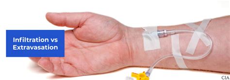 Image result for IV Line Infiltration