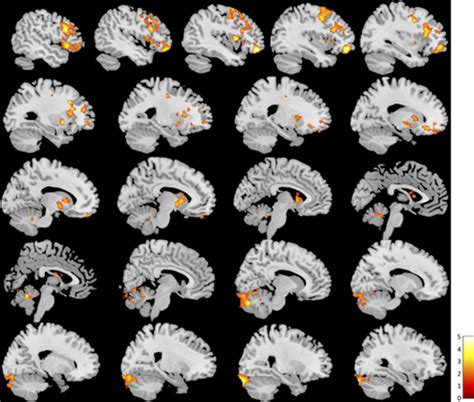 Image result for Cognitive Dysfunction in Mdd