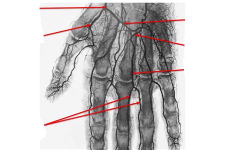 Image result for Hand Angiogram