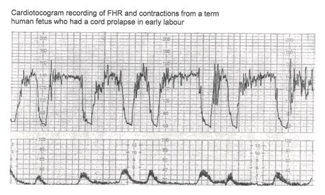 Image result for Variable Decelerations