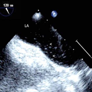 Image result for Intrapulmonary Shunt Bubble Study