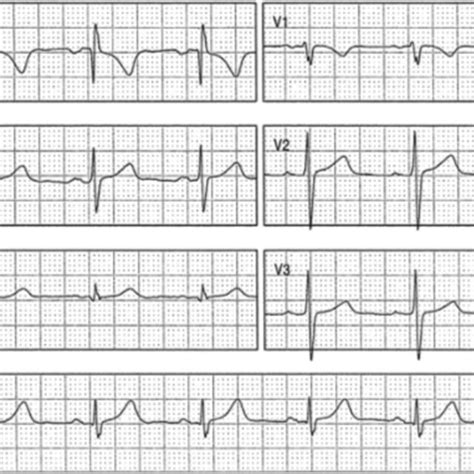 Image result for Normal EcG