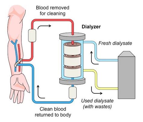 Image result for Dialysis Explained