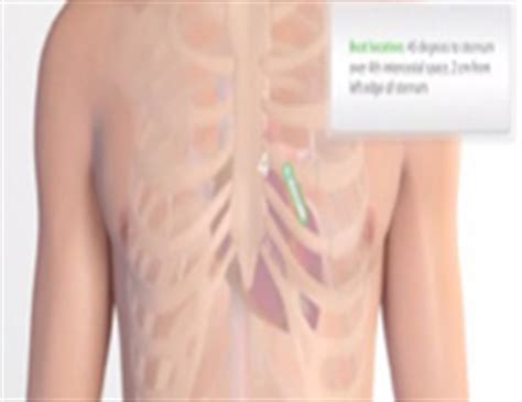 Image result for Insertable Loop Recorder