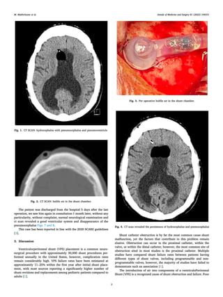 Image result for Intrapulmonary Shunt Bubble Study