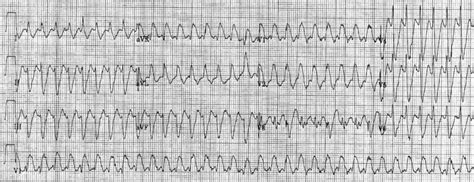 Image result for ECG Reading Practice
