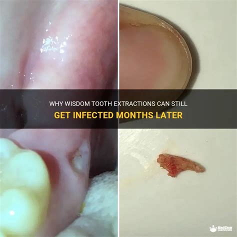 Image result for Infected Wisdom Tooth Extraction