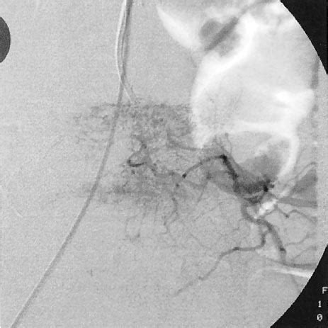 Image result for Spinal Angiogram