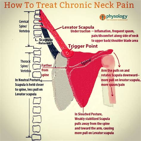Image result for Upper-Back Cyst Surgery