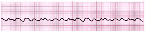 Image result for ACLS Rhythm Test