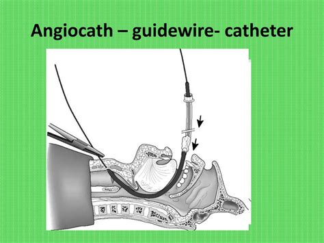 Image result for Retrograde Intubation