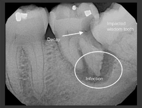 Image result for Impacted Wisdom Tooth Extraction
