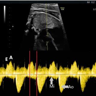Image result for 300Ms PR Interval