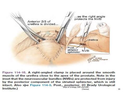 Image result for Open Radical Prostatectomy Surgery