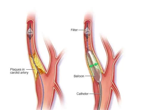 Image result for Simple vs Radical Prostatectomy