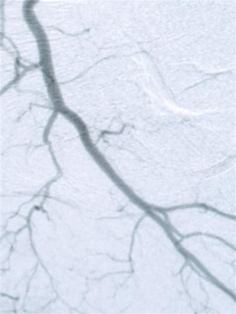 Image result for Different Types of Angiogram
