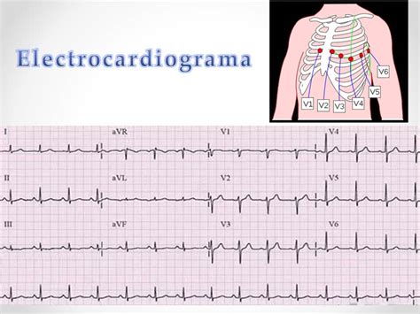 Image result for ECG 12 Derivaciones Normal