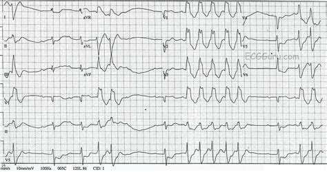 Image result for PR Interval ECG