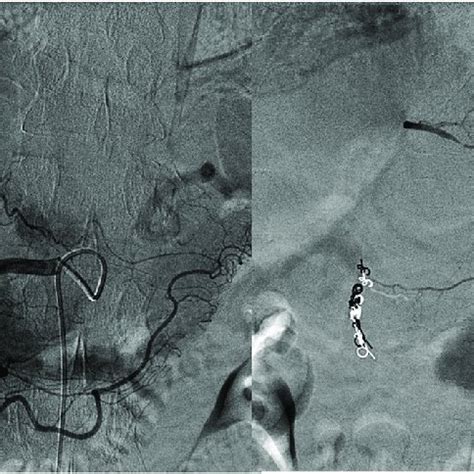 Image result for Angiogram with Embolization