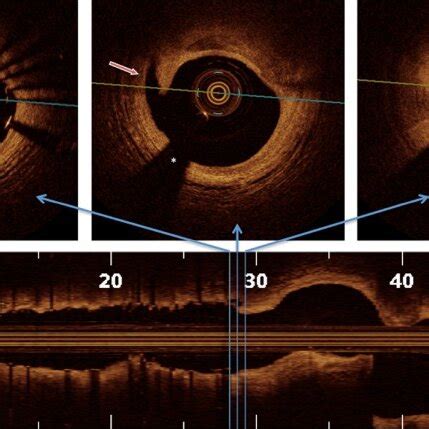 Image result for Oct Axial Resolution