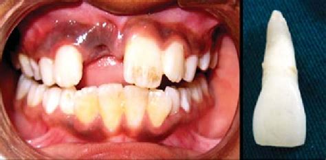 Image result for Avulsed Tooth