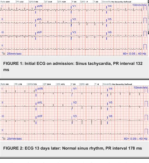 Image result for PR Interval Abnormalities