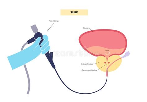 Image result for Transurethral Resection Procedure