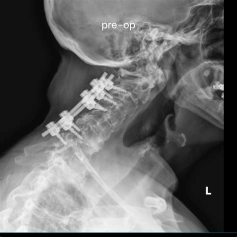 Image result for ACDF Surgery Is Serious