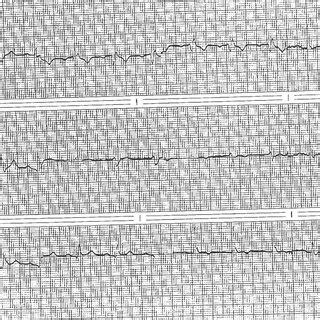 Image result for 300Ms PR Interval