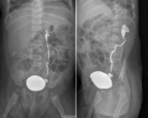 Image result for voiding cystourethrogram pediatric