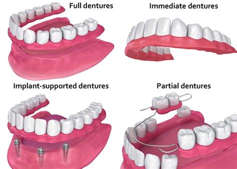 Image result for Denture Types
