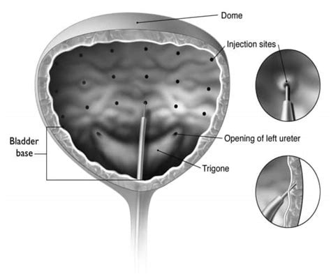 Image result for How Is Botox Injected into the Bladder