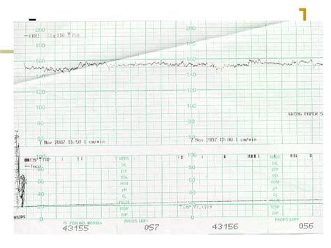 Image result for CTG and Partogram