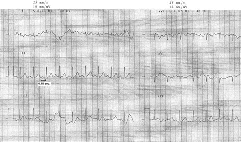 Image result for 300Ms PR Interval