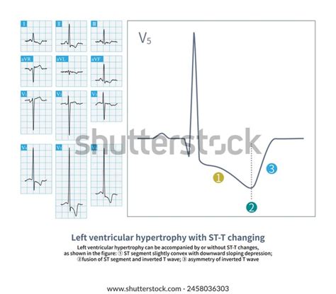 Image result for Types of ST Depression