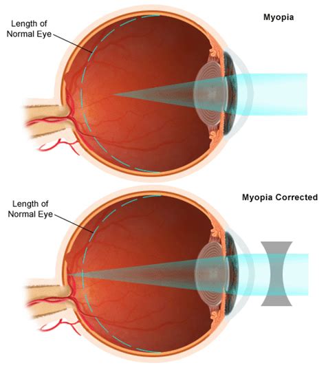 Image result for Vision Defects Myopia