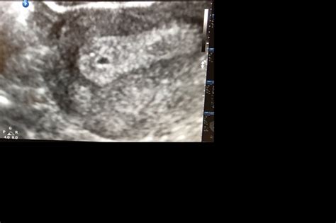 Normal 4 week ultrasound? - Glow Community